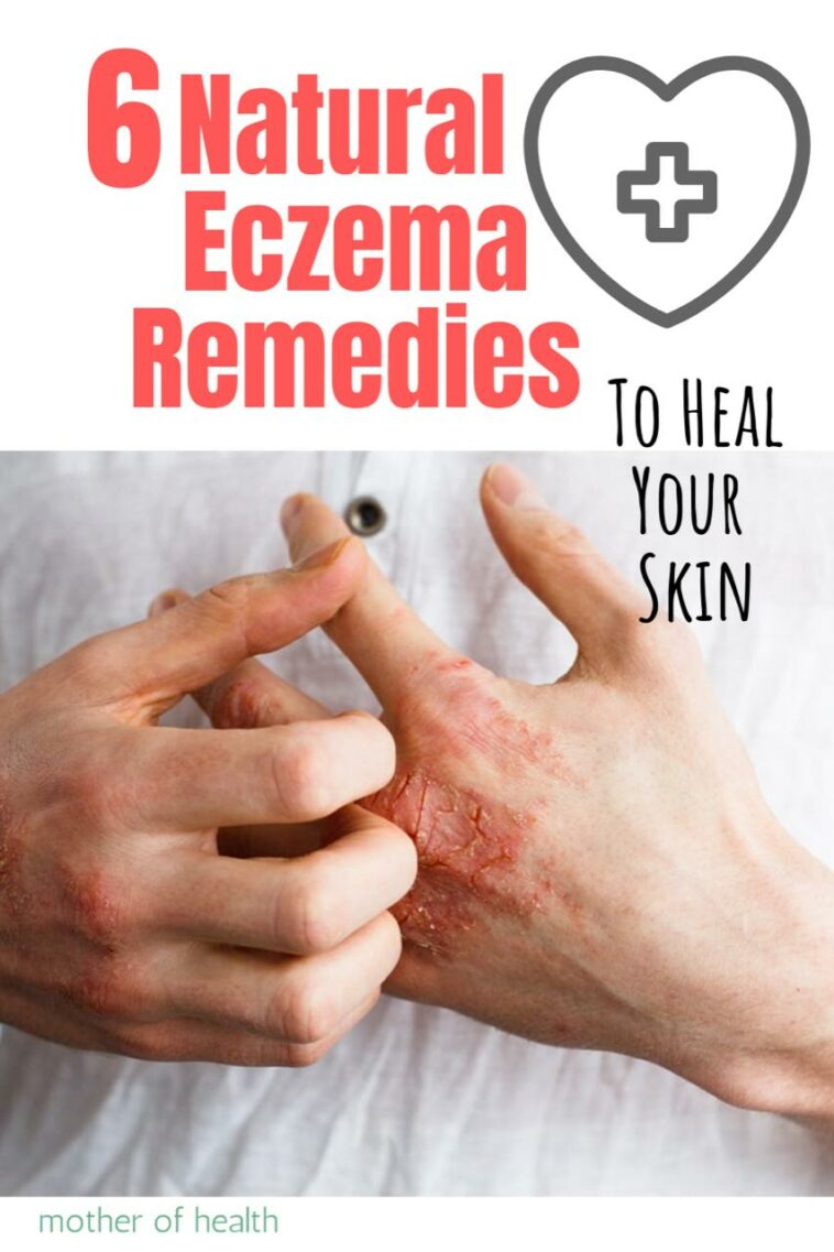 6 Natural Eczema Remedies To Heal Your Skin | Mother Of Health